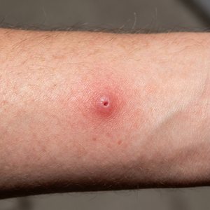 Come Riconoscere le Punture di Insetti? | Foto e Sintomi