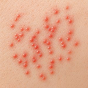 Come Riconoscere le Punture di Insetti? | Foto e Sintomi